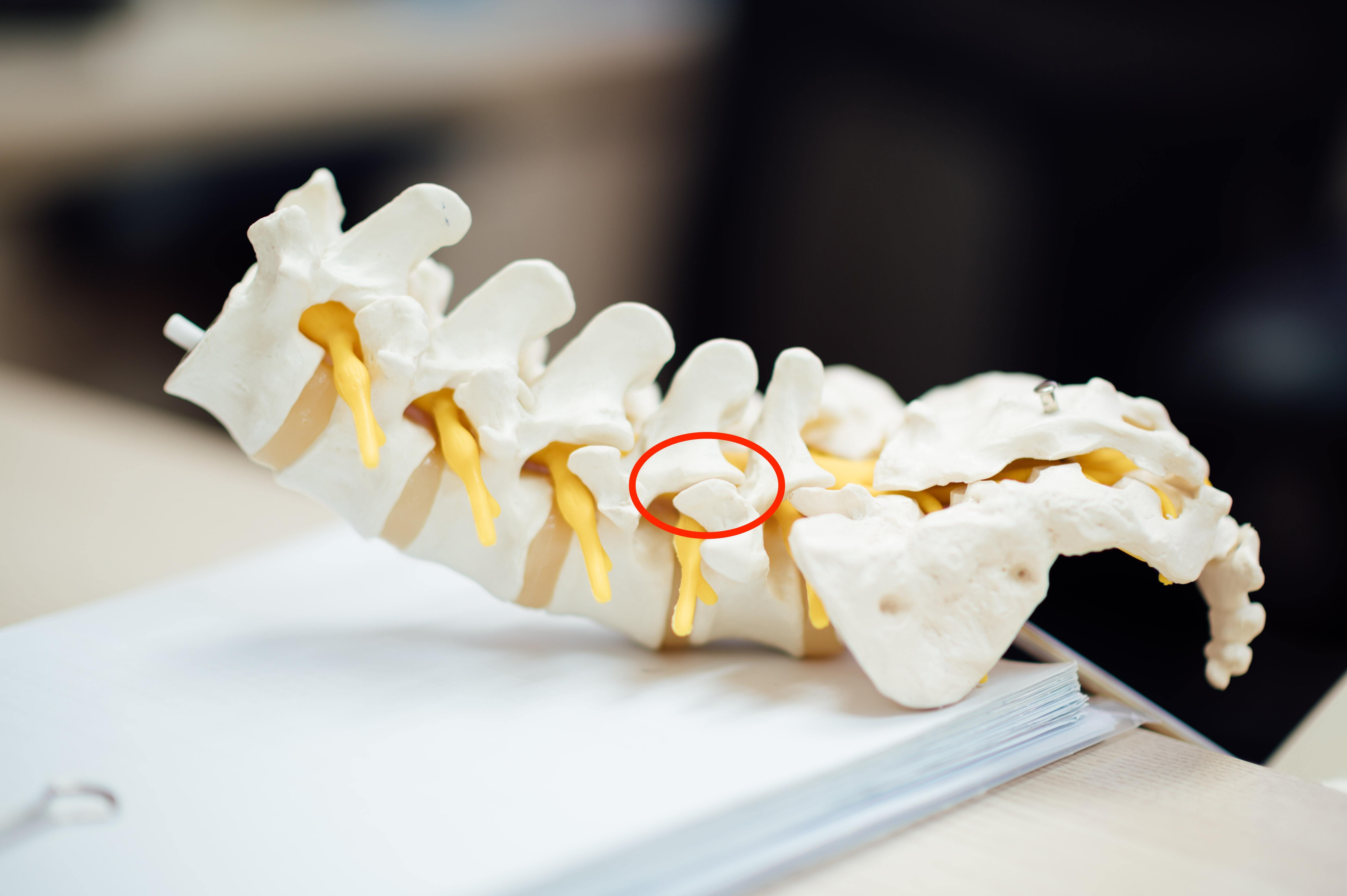 Arthrose du dos - Ligue suisse contre le rhumatisme
